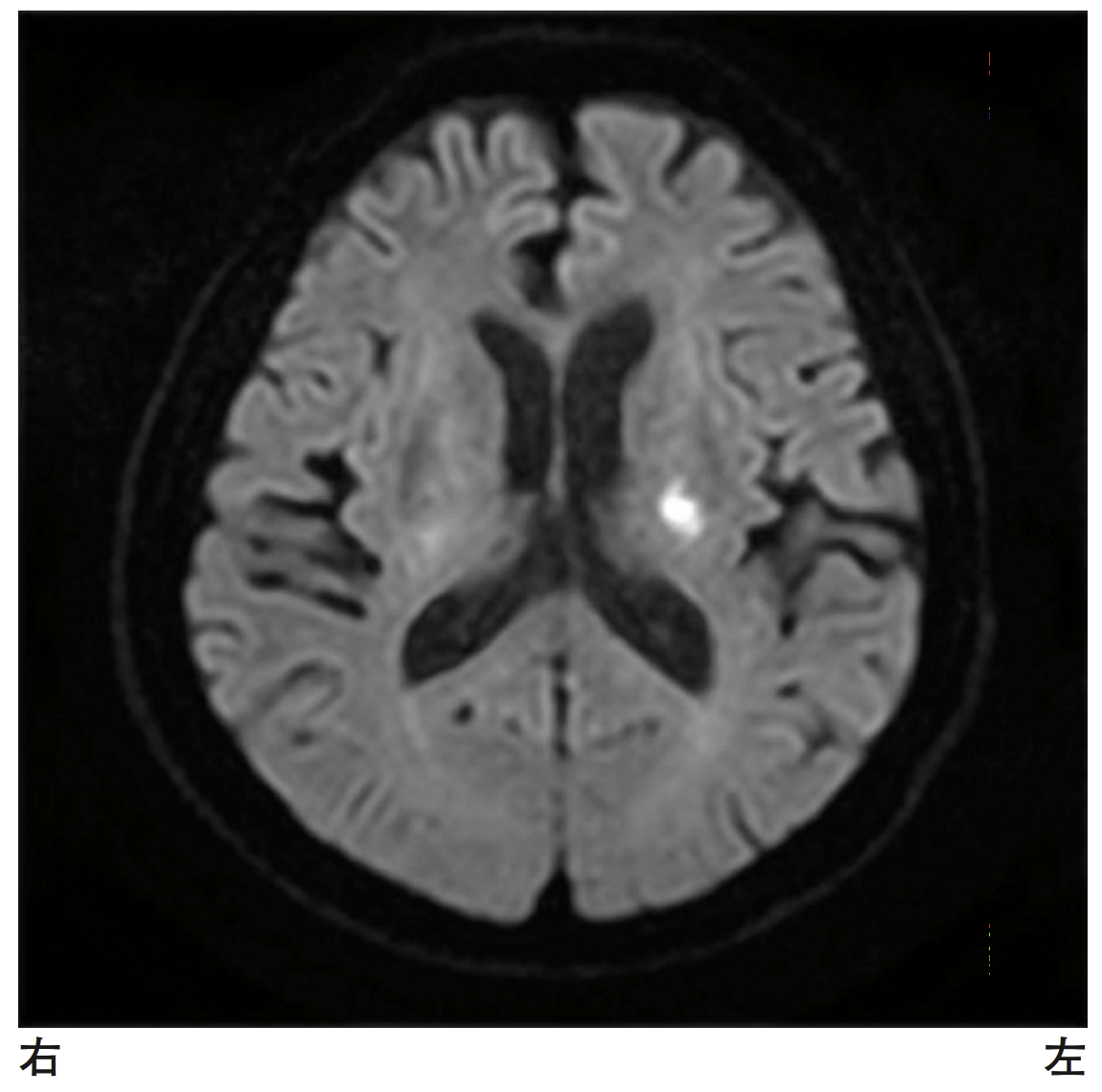 5 80歳の女性。右利き。脳梗塞急性期の頭部MRI拡散強調像を示す。この患者の症状で考えられるのはどれか。 - スタディメディマール